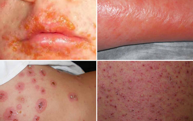 Foliculitis En La Cara Guía De La Piel Foliculitis (comezón Del